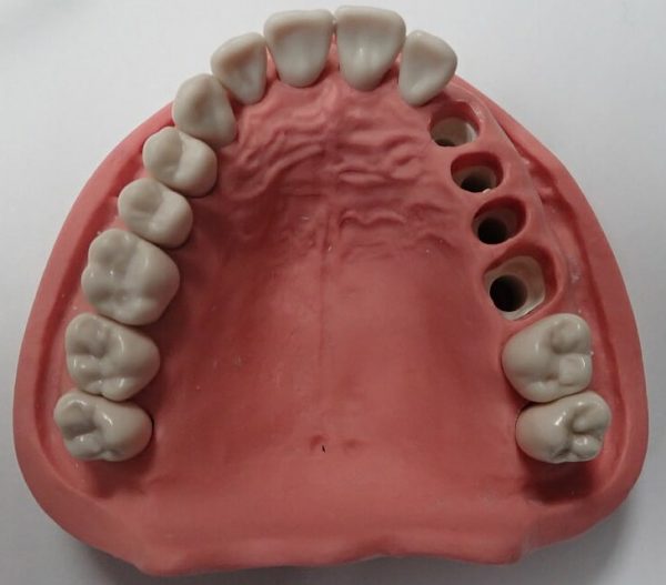 Partial Dentures | Dental Elementary