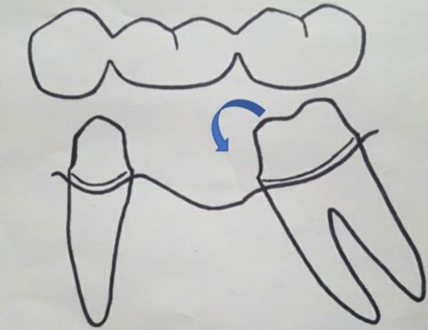 Bridges | Dental Elementary